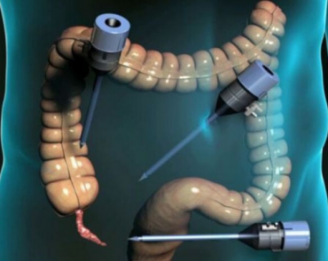 Appendix Surgery in Mumbai | laparoscopic appendectomy in mumbai